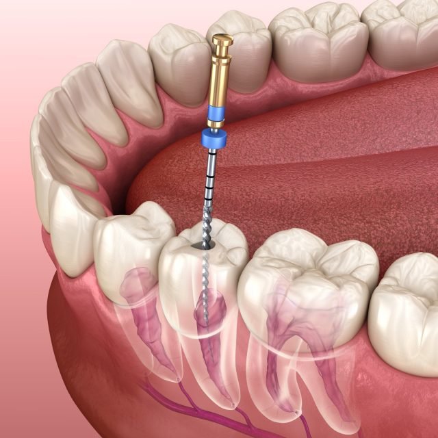 Root Canal – Dental Care and Implant Centre